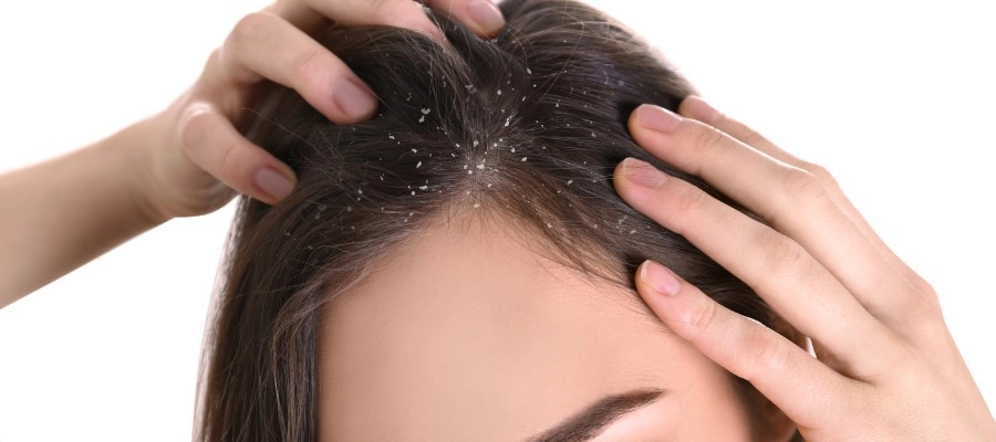 Como eliminar a caspa: causas, sintomas e soluções